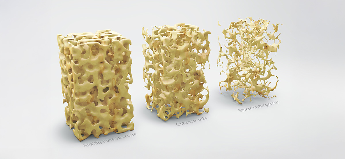Understanding Bone Loss - OsteoSmart