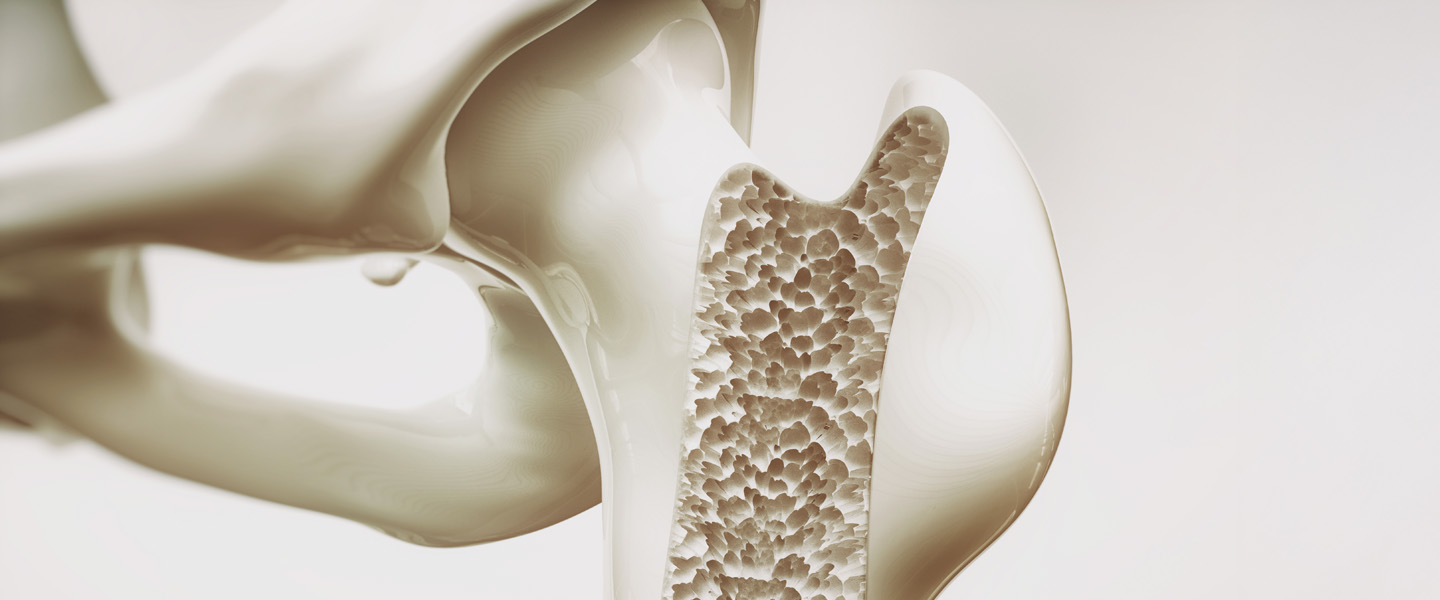 Osteoporosis - OsteoSmart